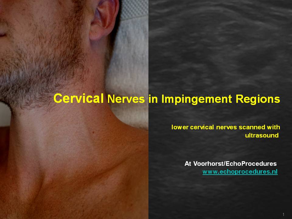 Proloque: Cervical Nerves in Impingement Regions, anatomy scanned with ...